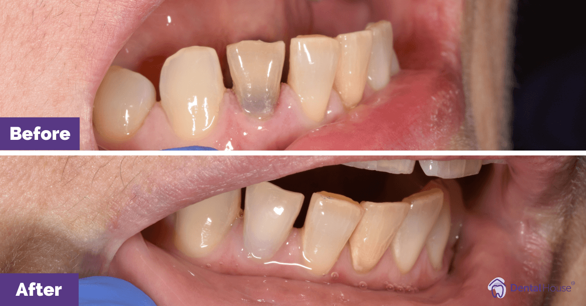 Internal Bleaching Case - Melton Dental House