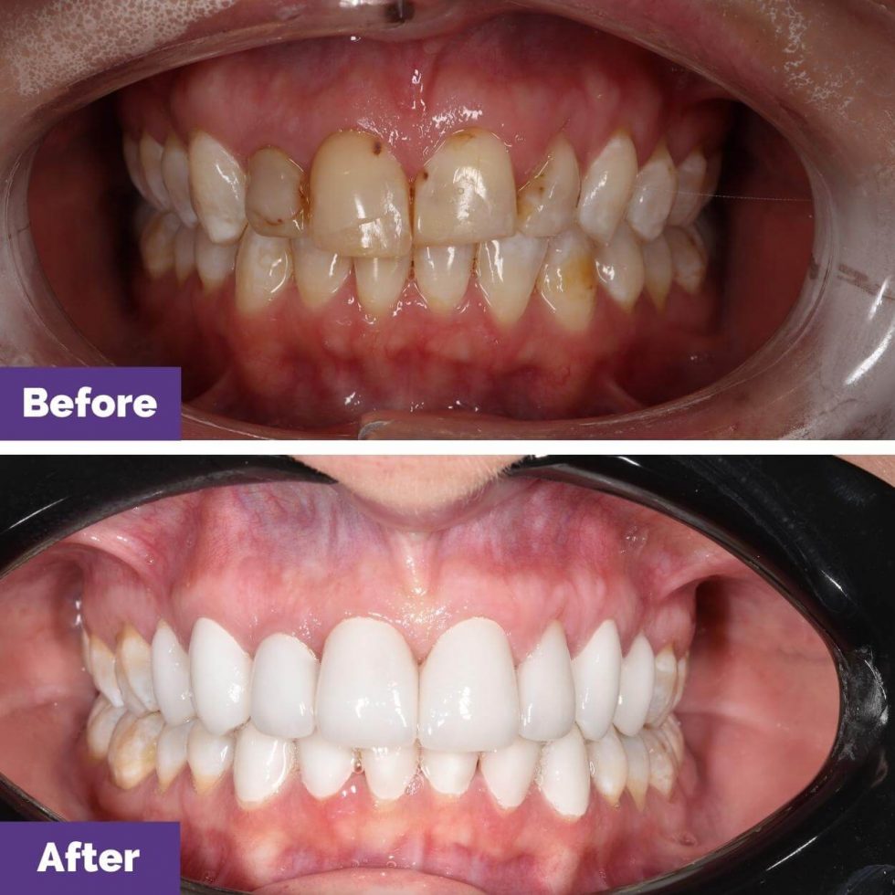Laser Gum Contouring Case - Melton Dental House